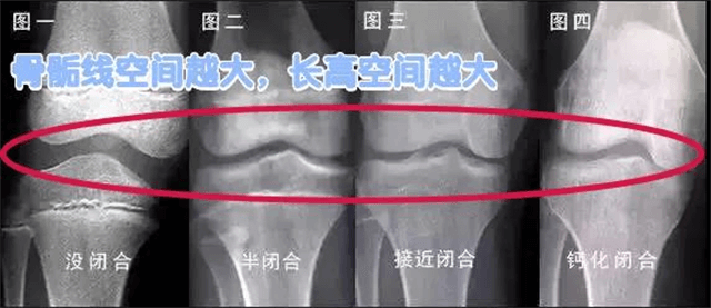 骨骺线半闭合阶段图骨骺线半闭合图片大山谷图库